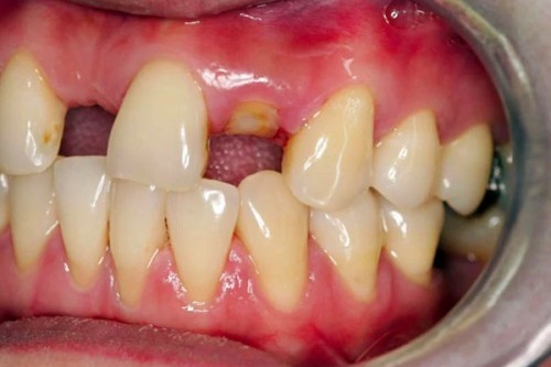 Precision Bridge - Skowronski Family Dentistry