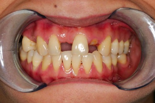 Precision Bridge - Skowronski Family Dentistry